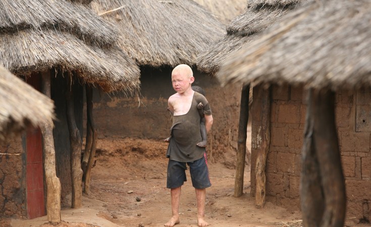 Tanzania: Govt Should Move Ahead With an Albinism Protection Plan ...